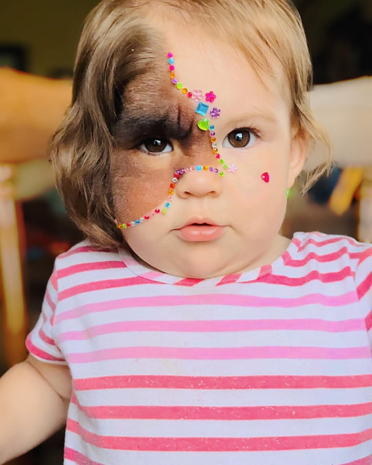 Mom Turns Daughter’s Rare Birthmark Into a Beautiful Superpower