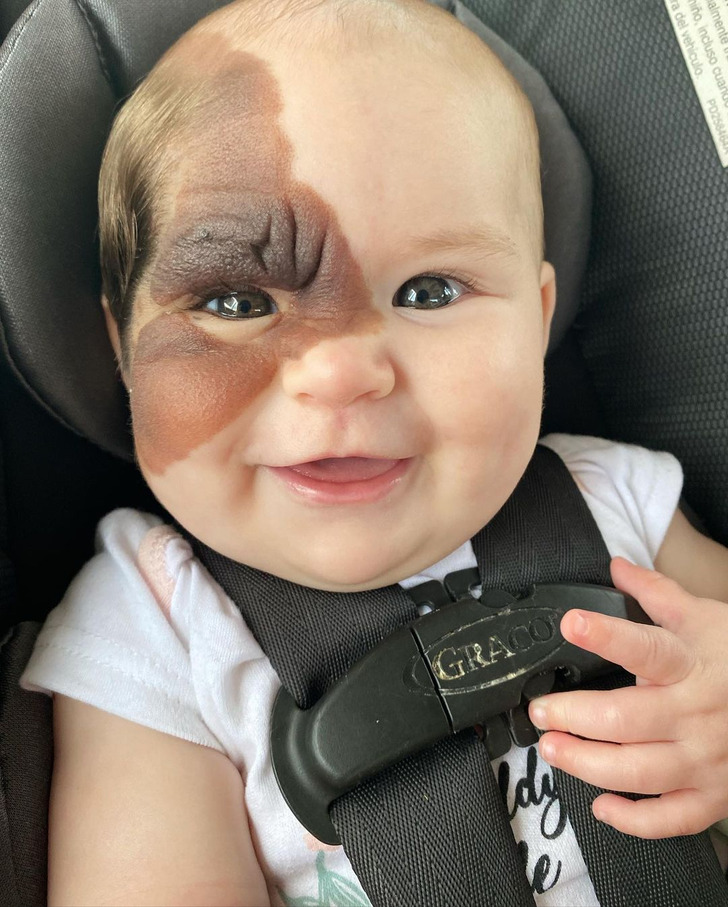 Mom Turns Daughter’s Rare Birthmark Into a Beautiful Superpower