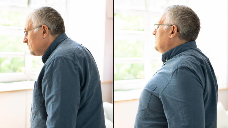 Lordoza - rodzaje, przyczyny i objawy. Jak rozpoznać i leczyć lordozę?