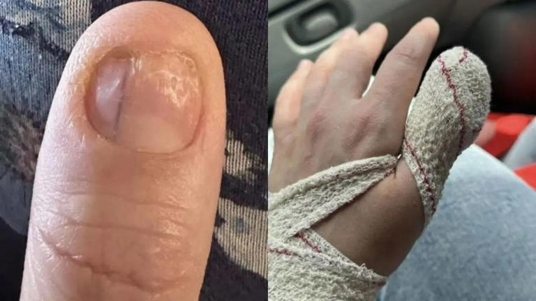 Woman Gets Diagnosed With Skin Cancer After Repeatedly Wearing Fake ...