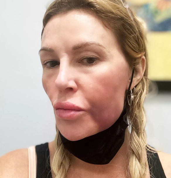 Brandi Glanville Burns Her Skin With Nair for This Reason