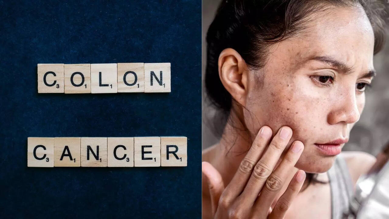 Colon cancer symptoms on skin: What you need to know