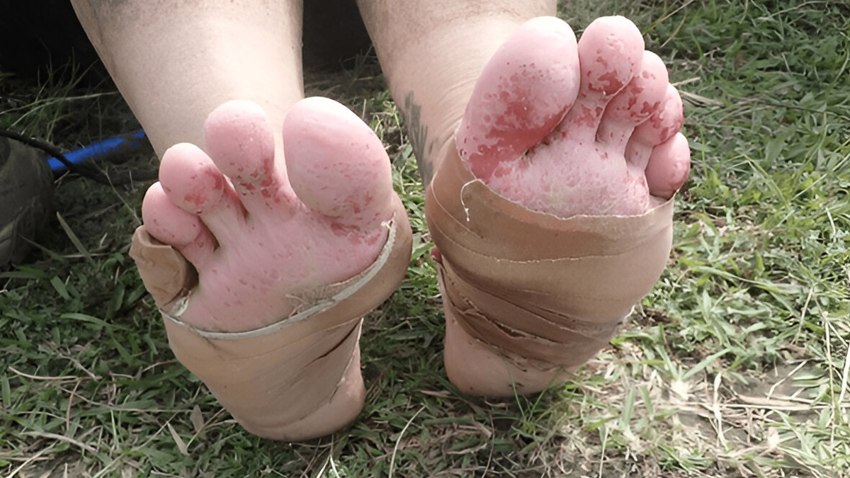Rainy Day Warning: How To Prevent ‘Trench Foot’ During Prolonged Wet ...