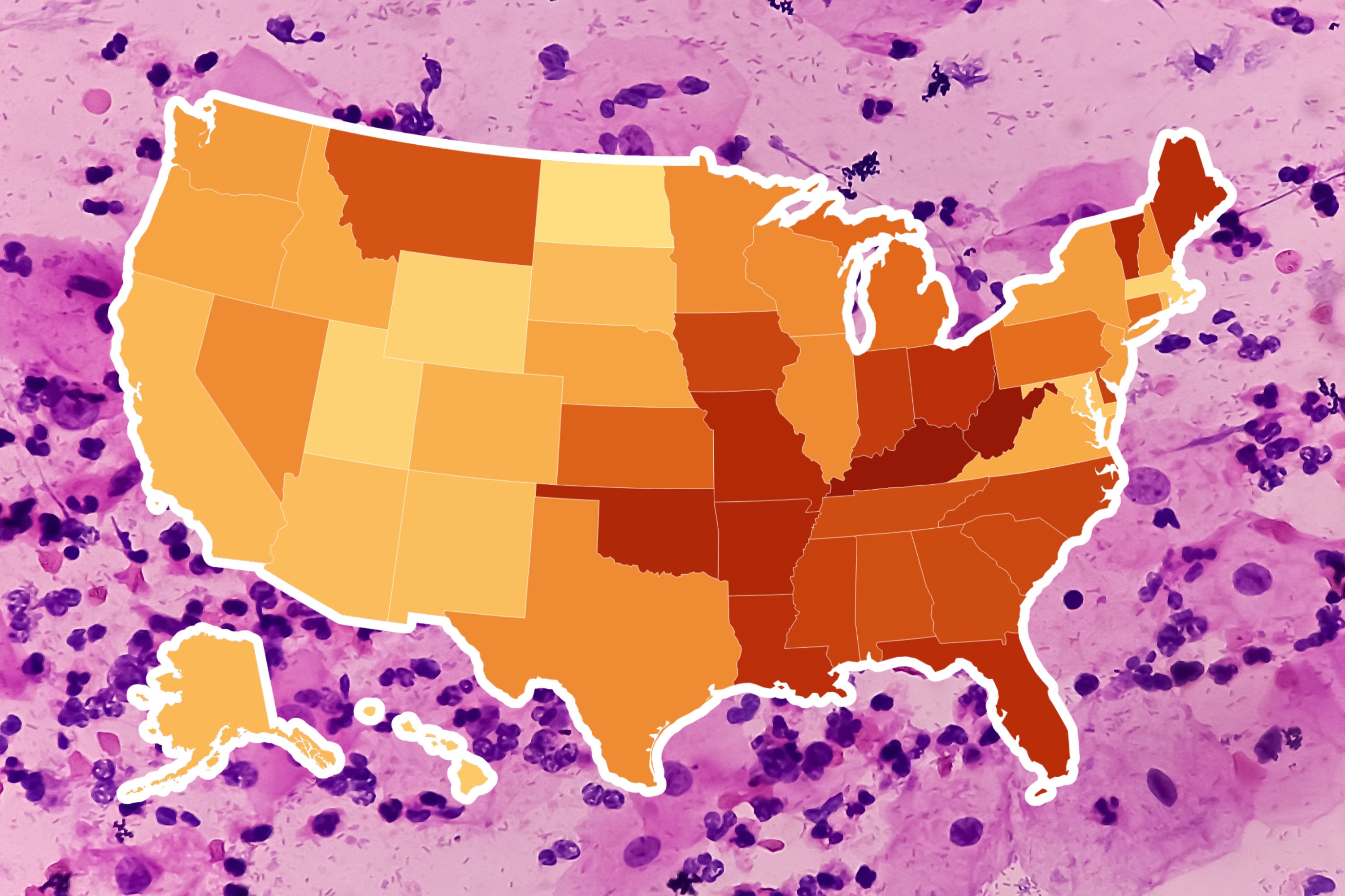 Map shows states with most HPV-related cancers as 1 in 3 unaware of link