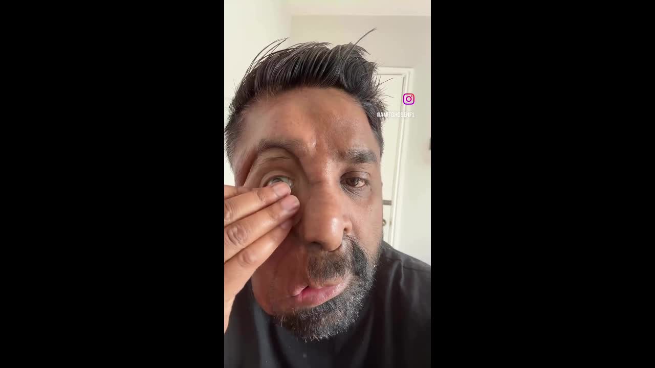 Breaking the stigma: Viral prosthetic eye video sparks global ...