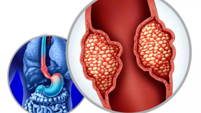 Cancer alert: Man’s first warning sign of esophageal cancer was ignored ...
