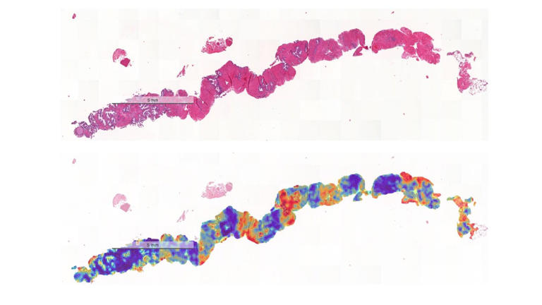 AI detects early prostate cancer in more than 80% of samples missed by ...