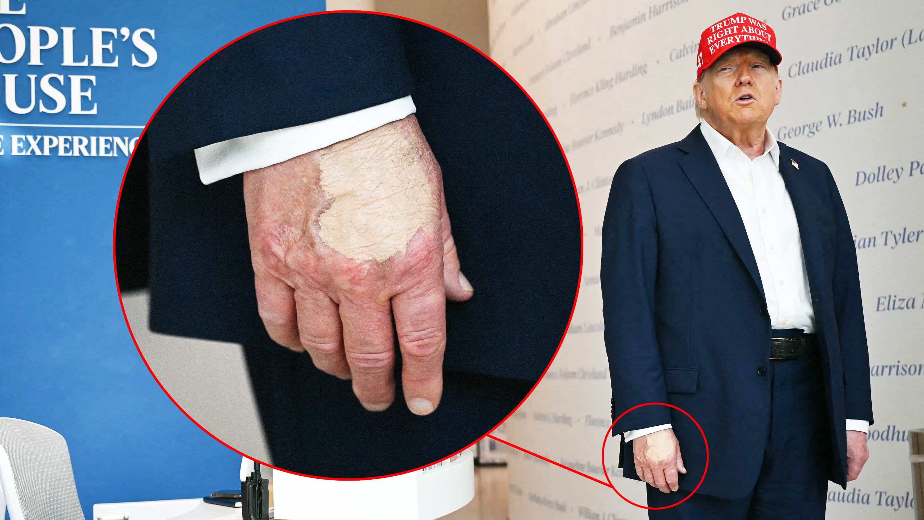 Trump Hand Makeup Raises New Health Questions After Cankles Concern