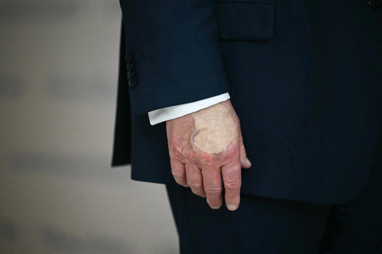 Trump Hand Makeup Raises New Health Questions After Cankles Concern