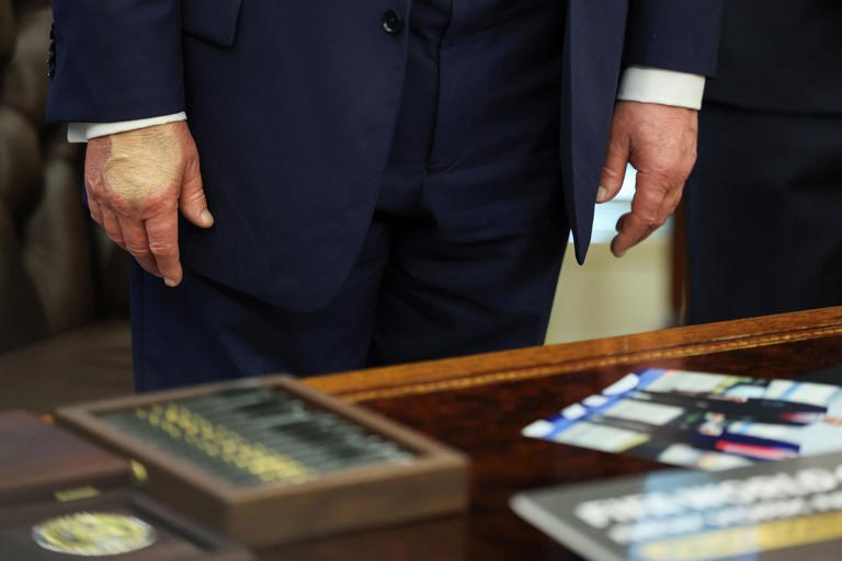 Trump Hand Makeup Raises New Health Questions After Cankles Concern