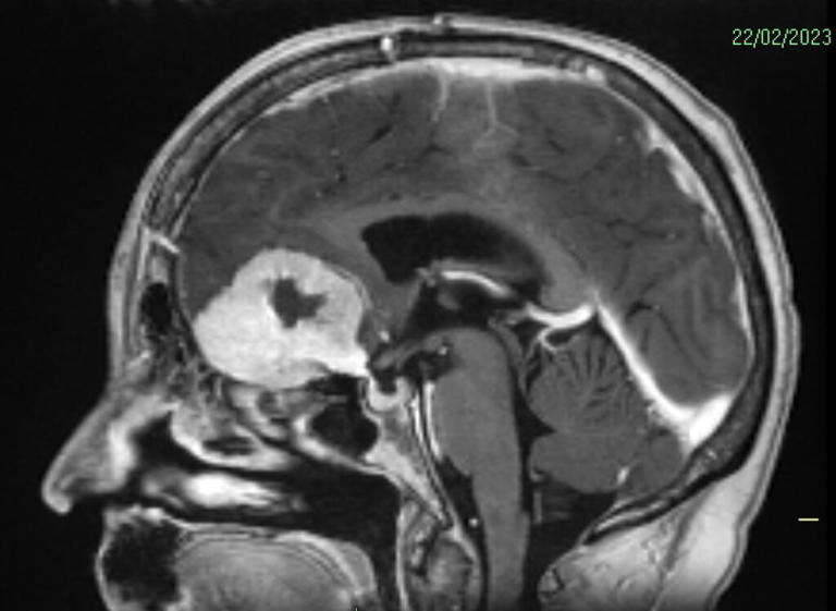 First in the world to have a brain tumour removed through her eyebrow