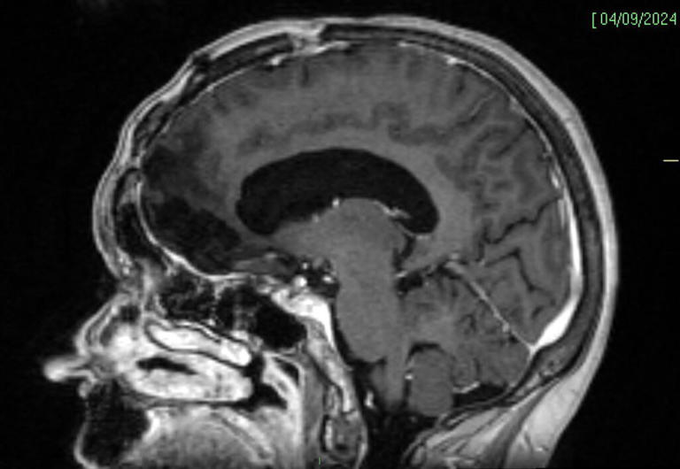 First in the world to have a brain tumour removed through her eyebrow