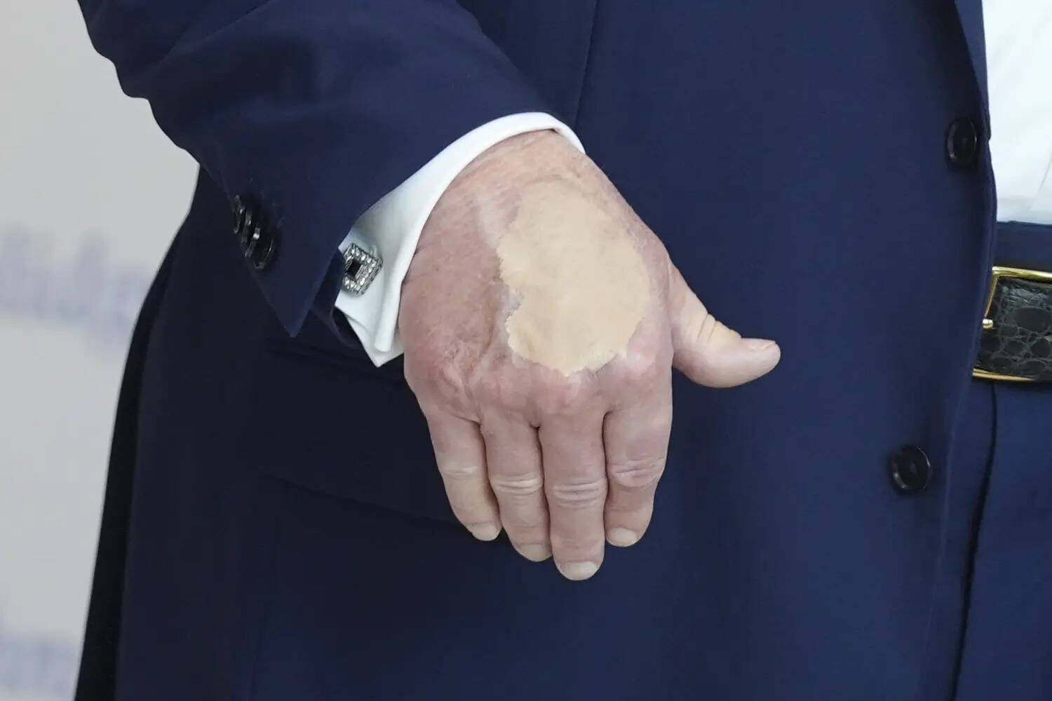 Trump health scare: Mystery spot on his hand sparks fresh fears over ...