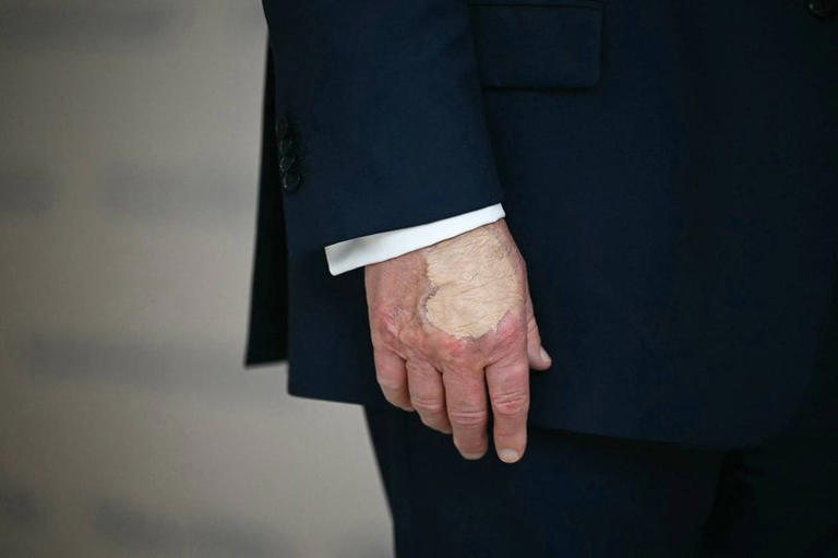 Donald Trump photo shows large mark on hand as fears swirl over his ...