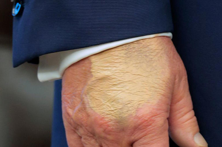 Trump's hand pictured smeared in huge chunk of make up amid rampant ...