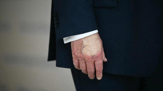Trump health update: Why POTUS has repeated bruises on his hand. White ...