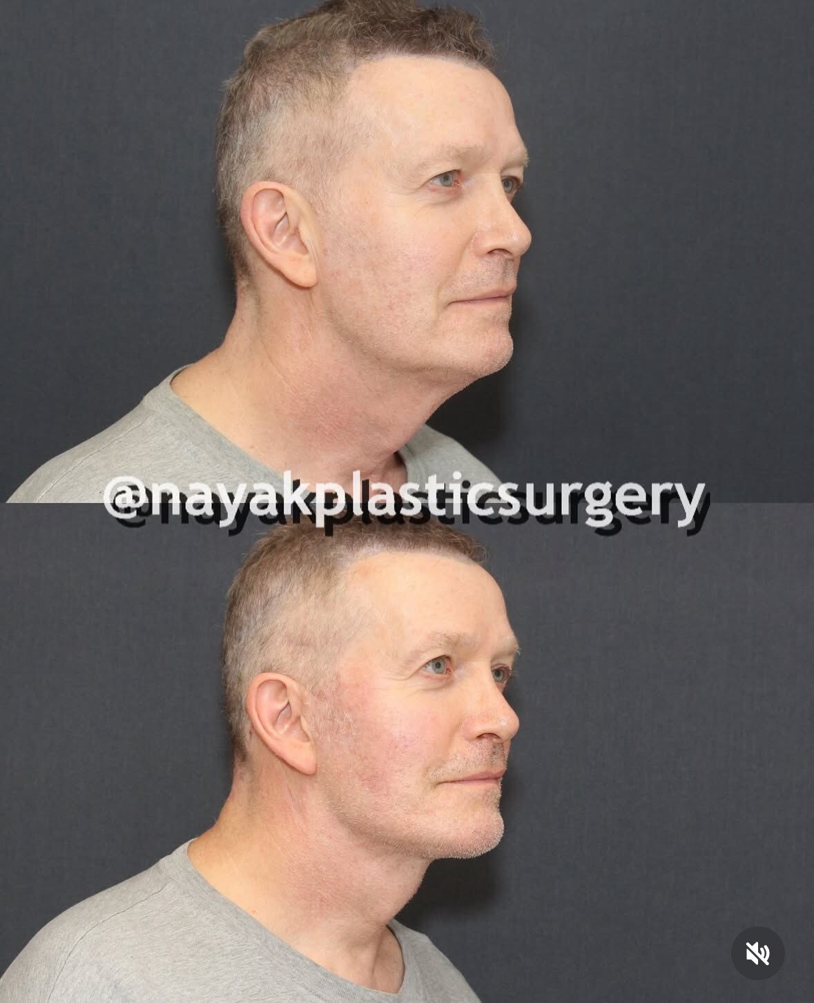65-Year-Old Gets Dramatic ‘Leading Man’ Plastic Surgery Transformation