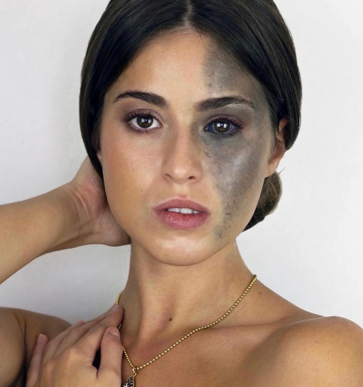 Model With Giant Birthmark Shares Her Journey to Self-Love