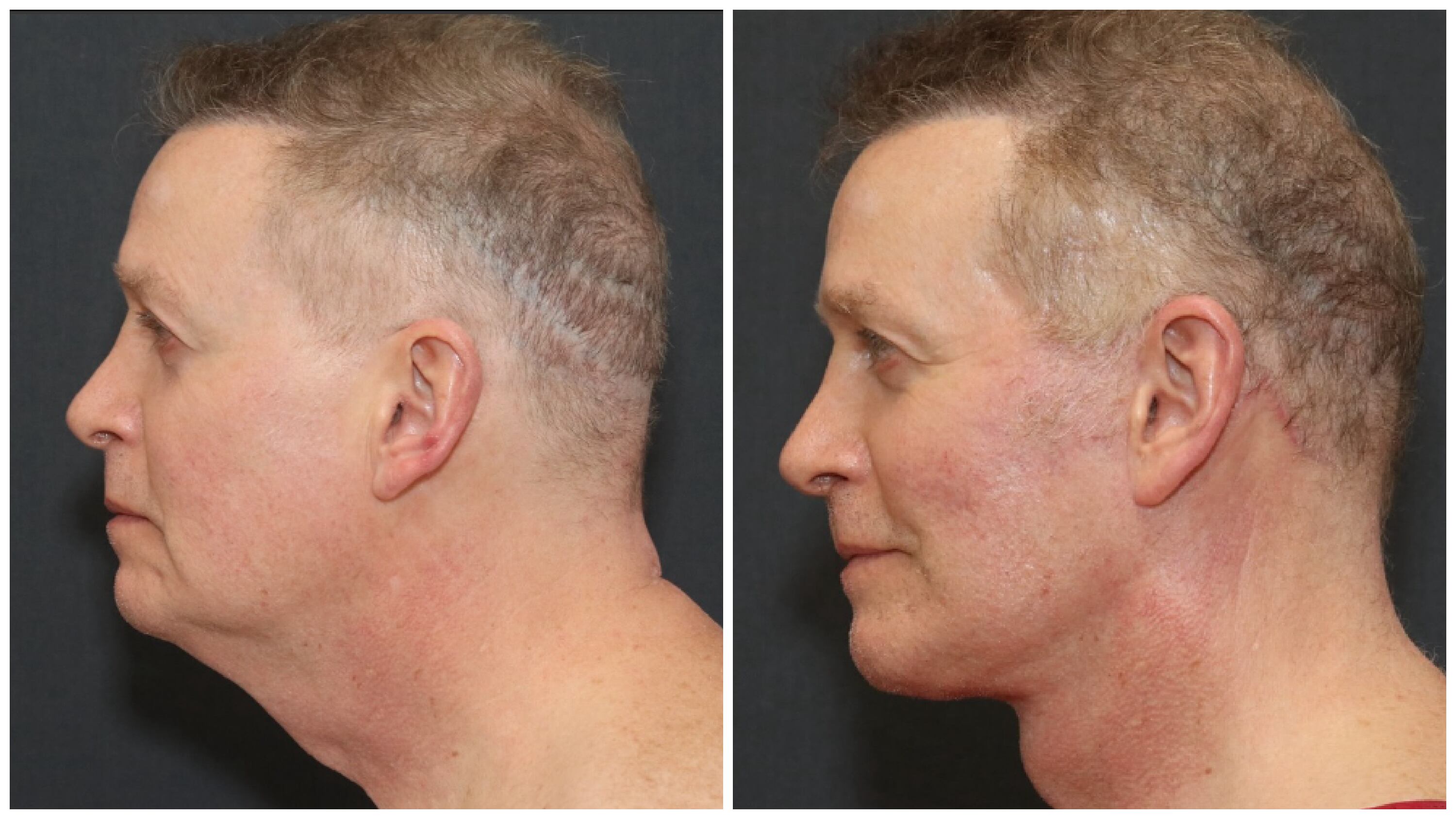 65-Year-Old Gets Dramatic ‘Leading Man’ Plastic Surgery Transformation