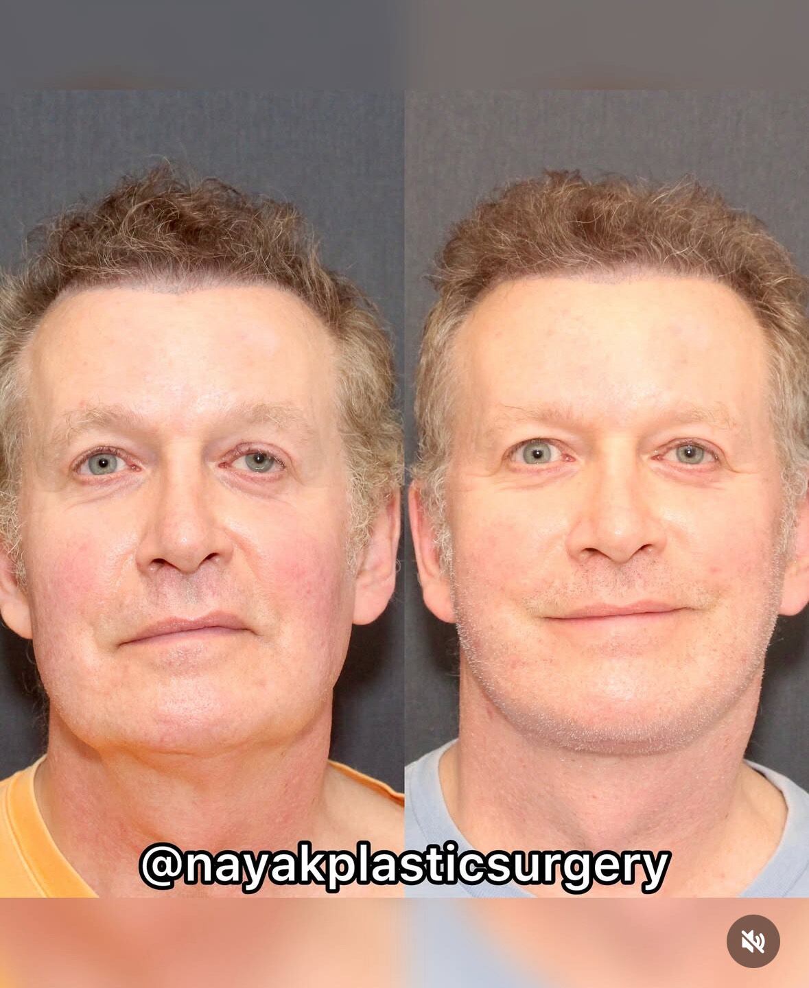 65-Year-Old Gets Dramatic ‘Leading Man’ Plastic Surgery Transformation
