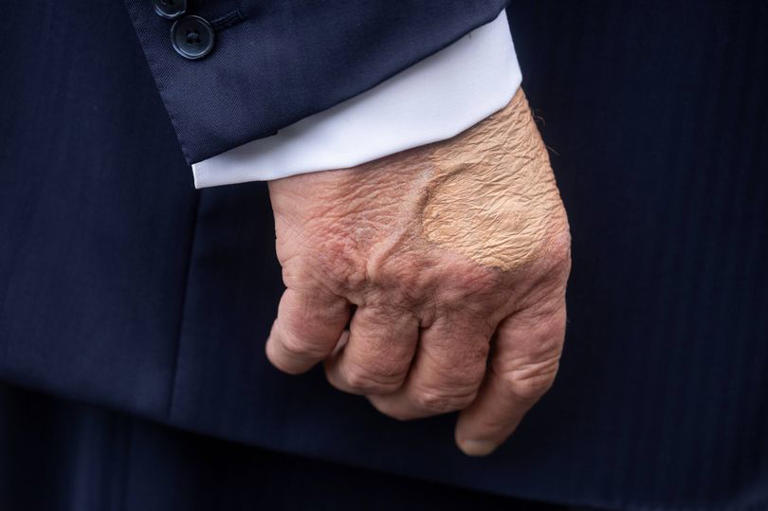 Trump's swollen cankles spark health concern as weird hand make-up ...