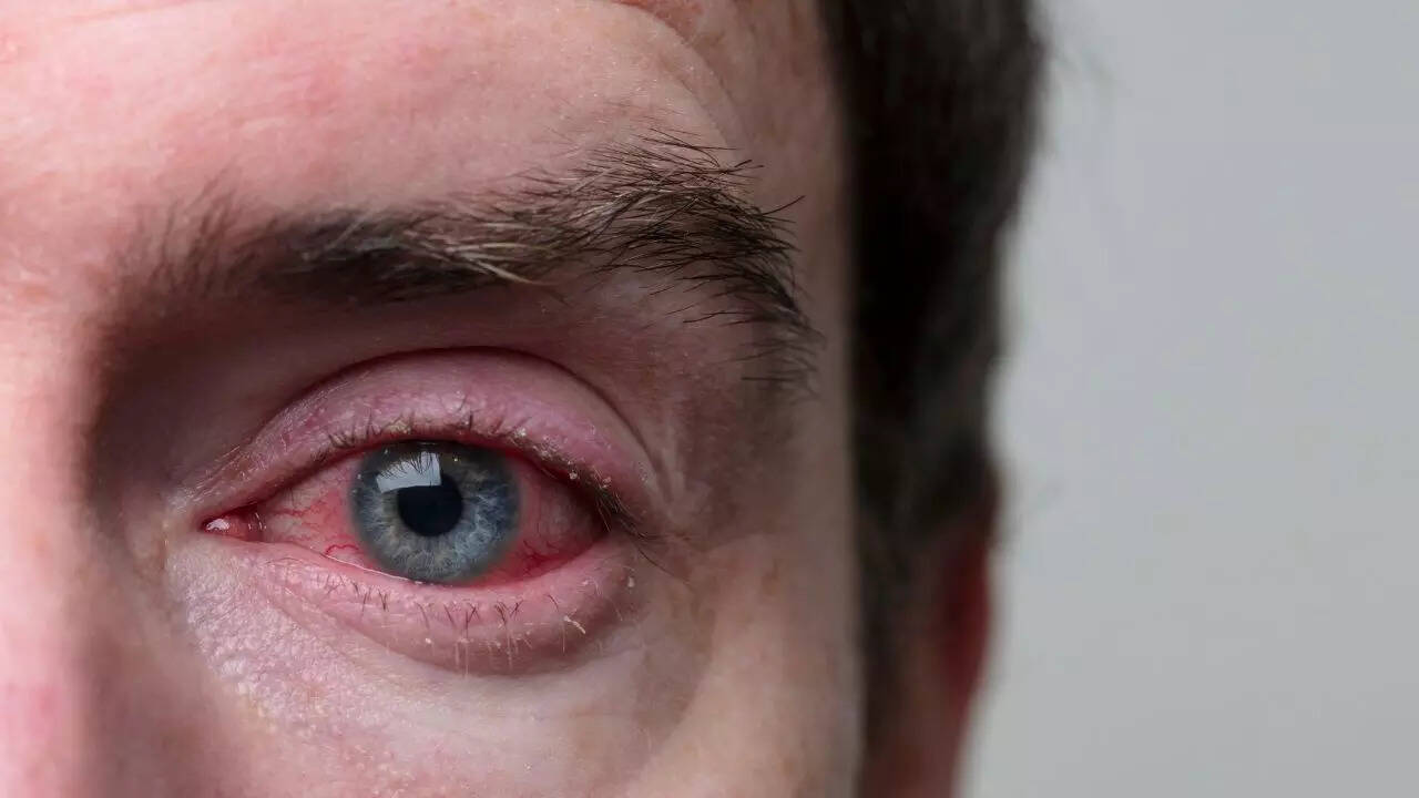 Blood in the eye: Should you be concerned about that red patch?