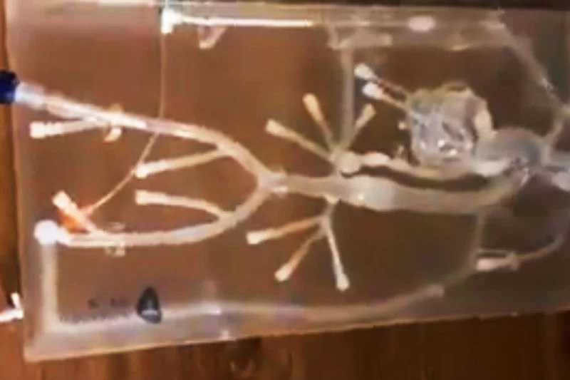 Moroccan doctor unveils groundbreaking device to filter blood inside ...