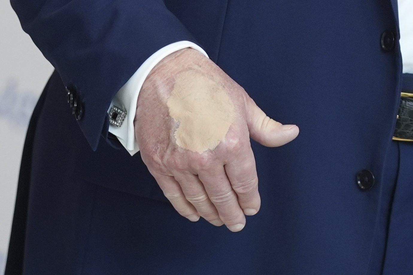 Why did Donald Trump have a strange patch on his hand?