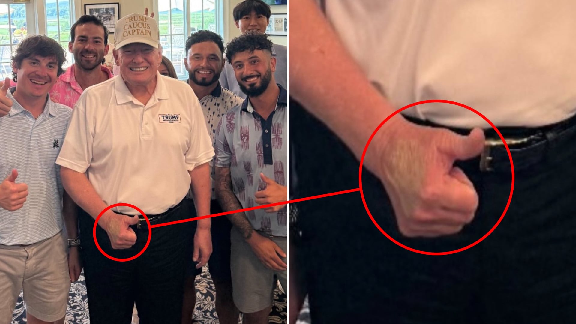Trump, 79, Soothes Bruised Hand With Surprise Golf Outing
