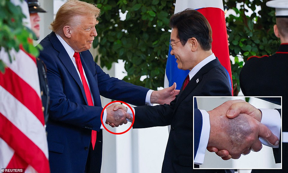 Health concerns as more bruises seen on Trump's hand