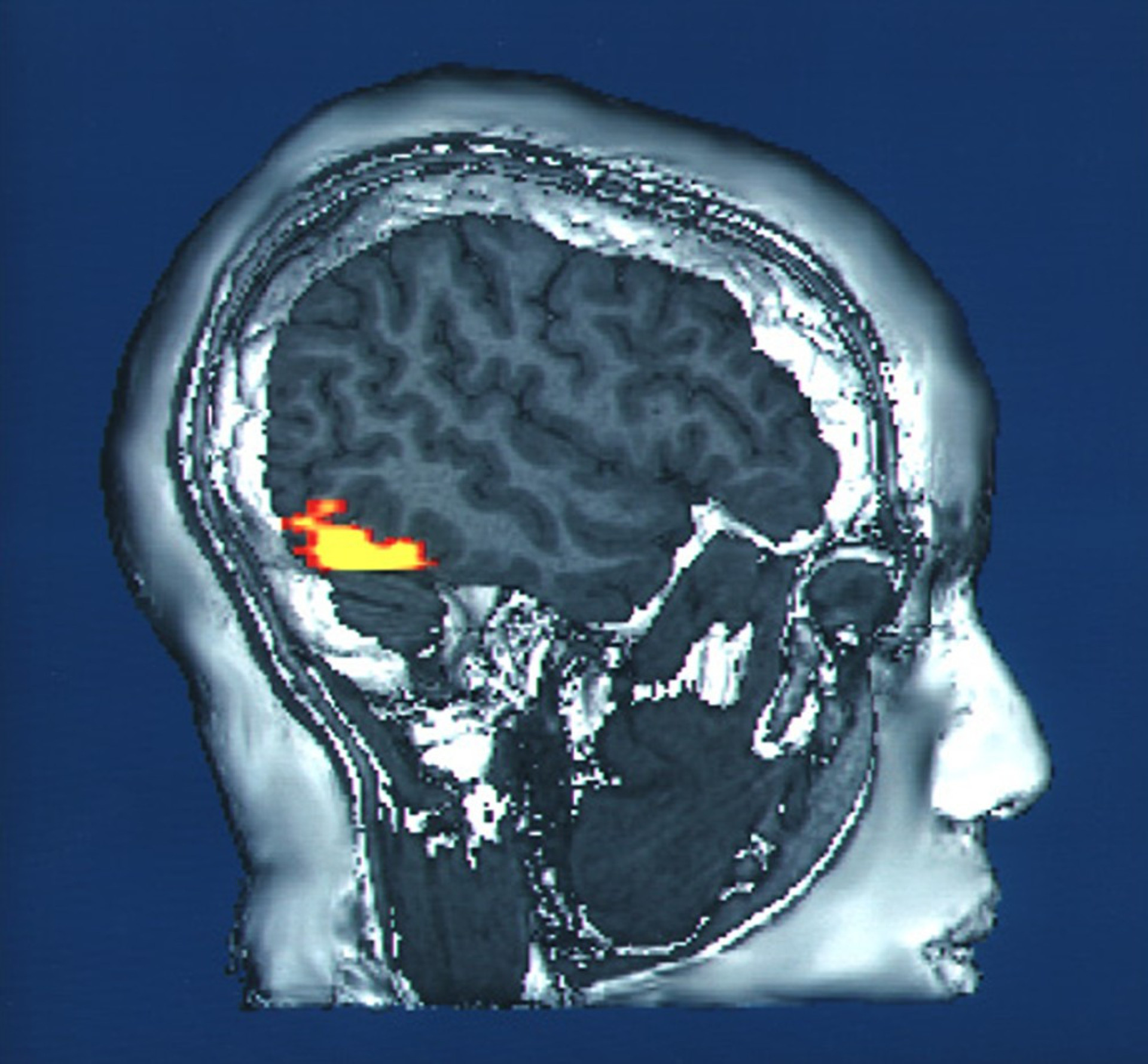 The rare disorder that makes people see demon-like faces