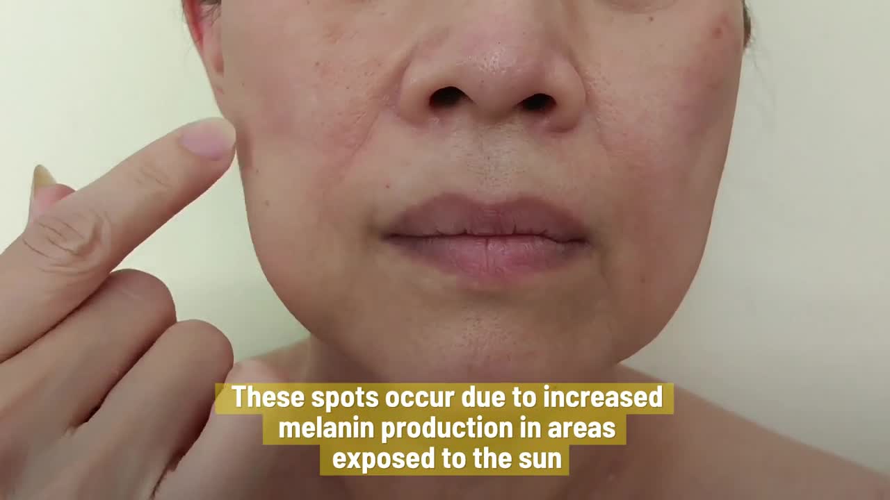 Melasma: Know The Main Symptoms & How To Prevent It