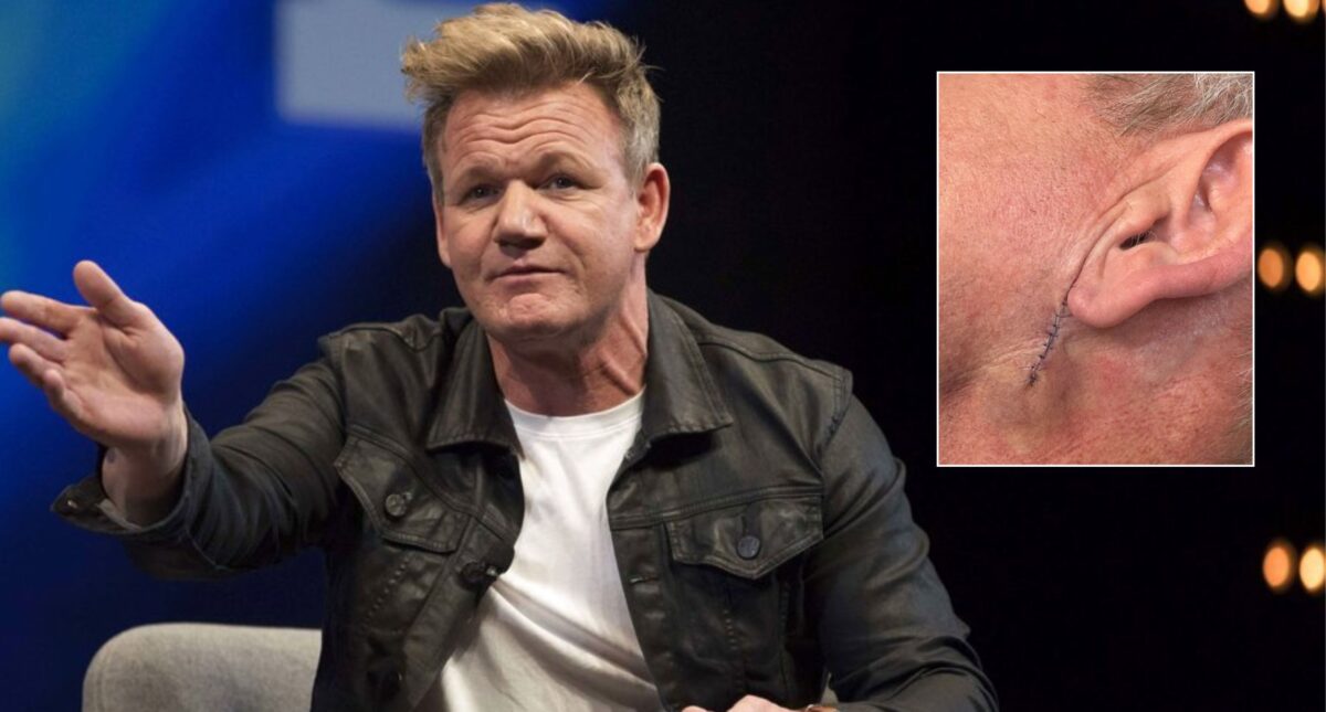 Gordon Ramsay Shares Surgery Scar as He Reveals Skin Cancer Diagnosis ...
