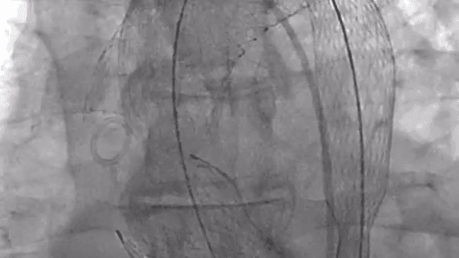 Western N.C. hospital pioneers stroke prevention device in heart ...