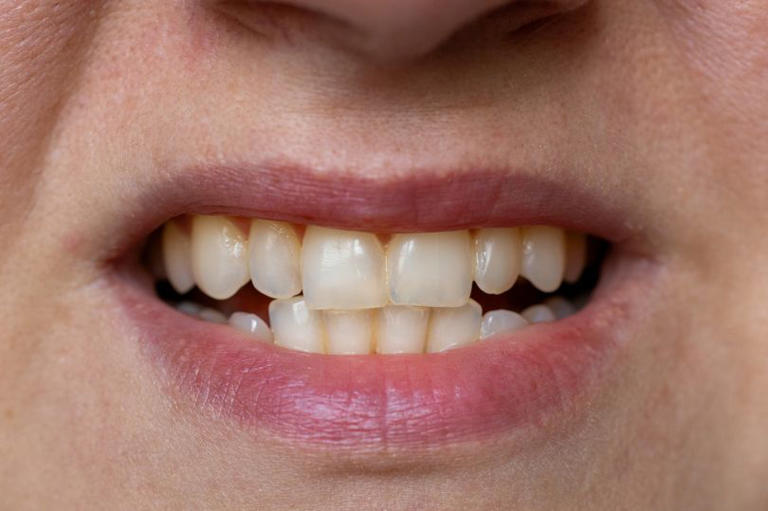 What colour of your teeth really means - from liver disease to fluorosis