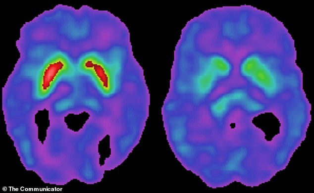 The 'harmless' virus that could be silently fueling Parkinson's disease ...