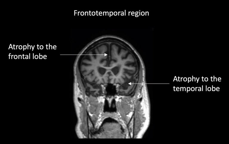 Restrictive criteria for frontotemporal dementia lead to late treatment