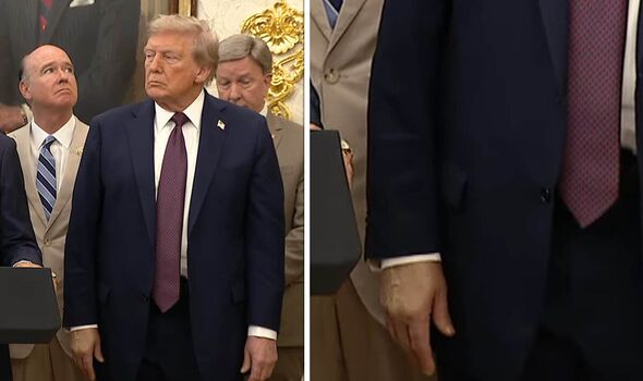 Donald Trump health fears erupt as 'major discoloration' spotted on hand