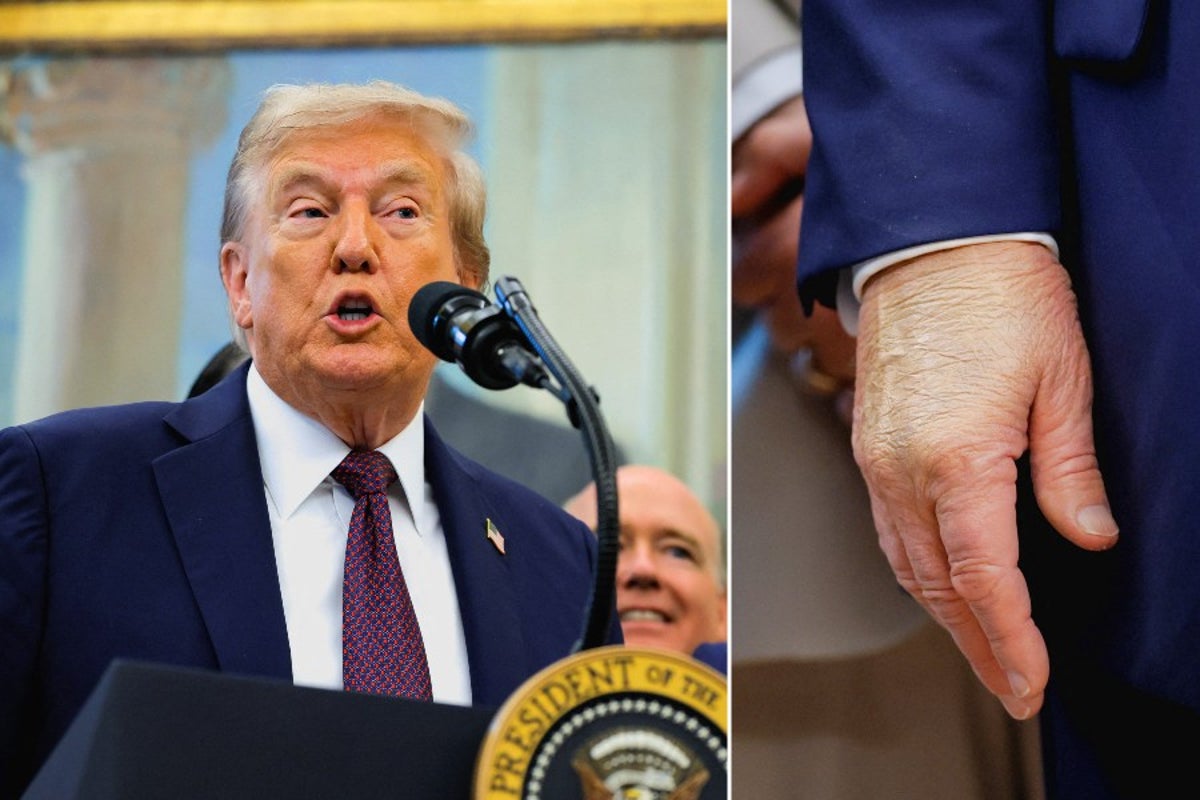 Trump blames the ‘so fake’ media for health rumors - but still sports a ...