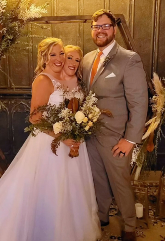 Cặp song sinh dính liền bất ngờ xuất hiện cùng em bé sơ sinh