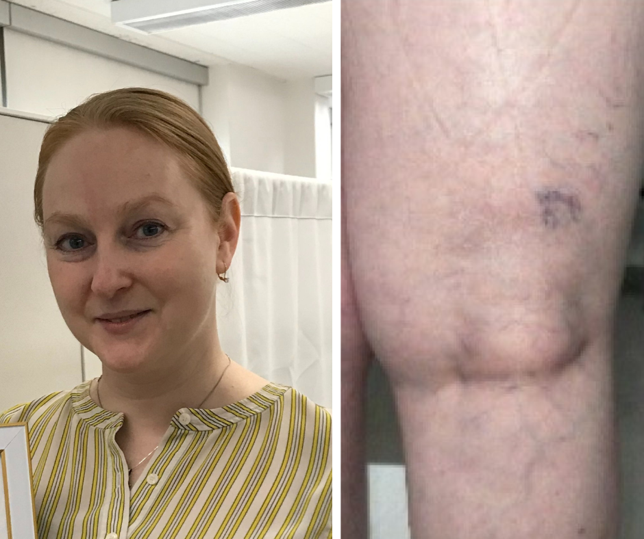 “I have same vein condition as Trump – I wake up exhausted.”