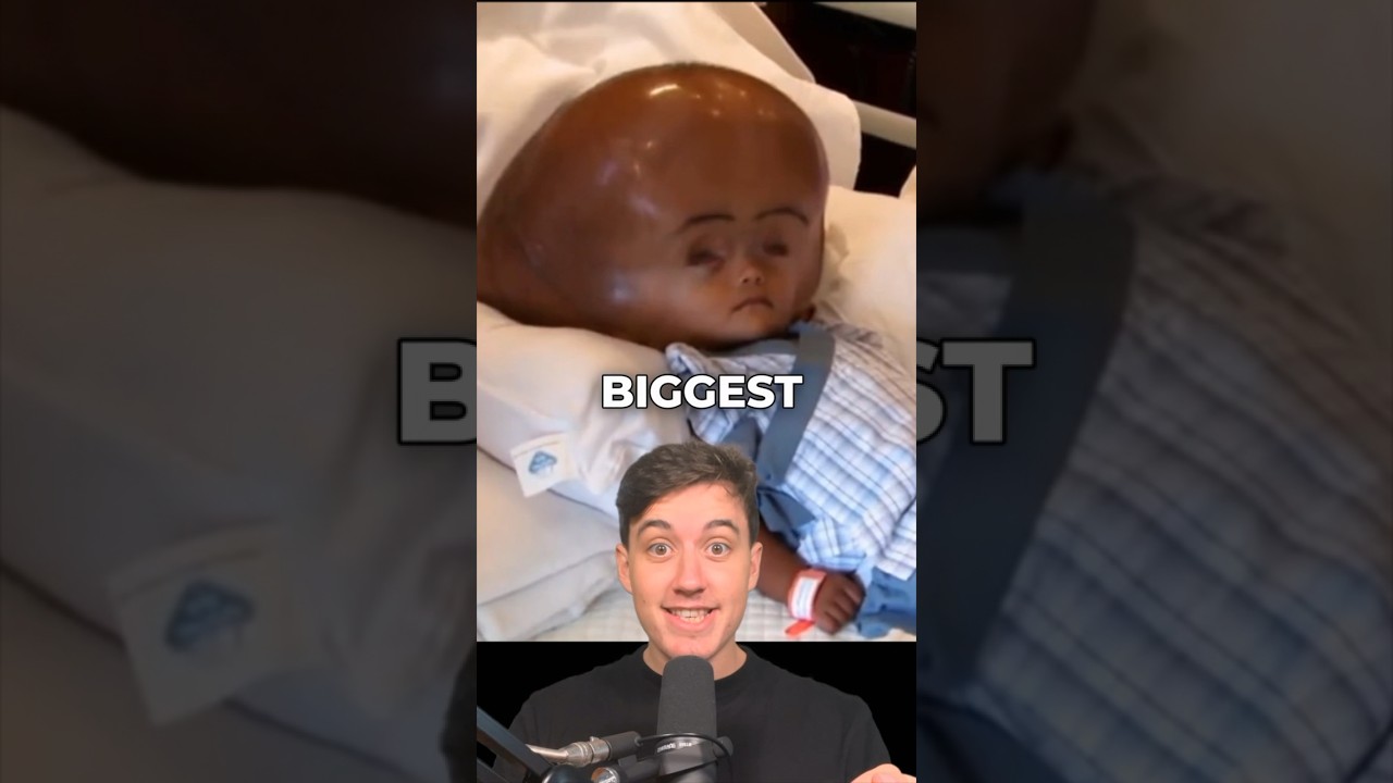 Cases of individuals known for exceptionally large body features