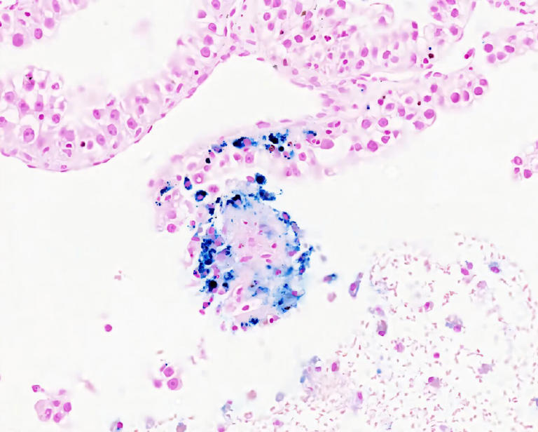 Cancer's iron theft: Research uncovers why bone metastasis often leads ...
