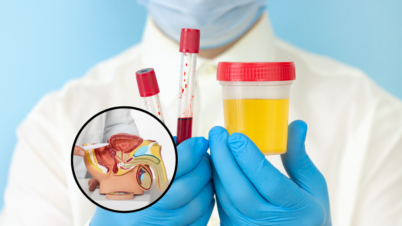 Prostate Cancer Can Now Be Detected Through These Identifiers In A Non ...