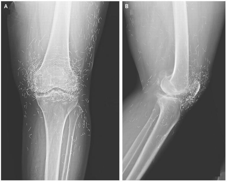 Diagnostic dilemma: Woman's severe knee pain reveals 'golden threads ...