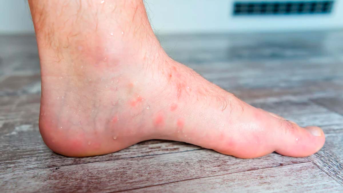 Can You Get Sick from Walking in Puddles? Find Out Here