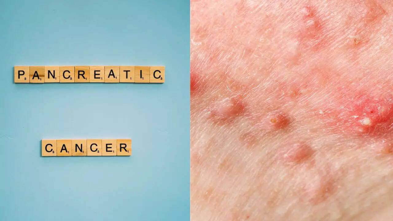 Pancreatic cancer symptoms on skin: Early signs you shouldn’t ignore