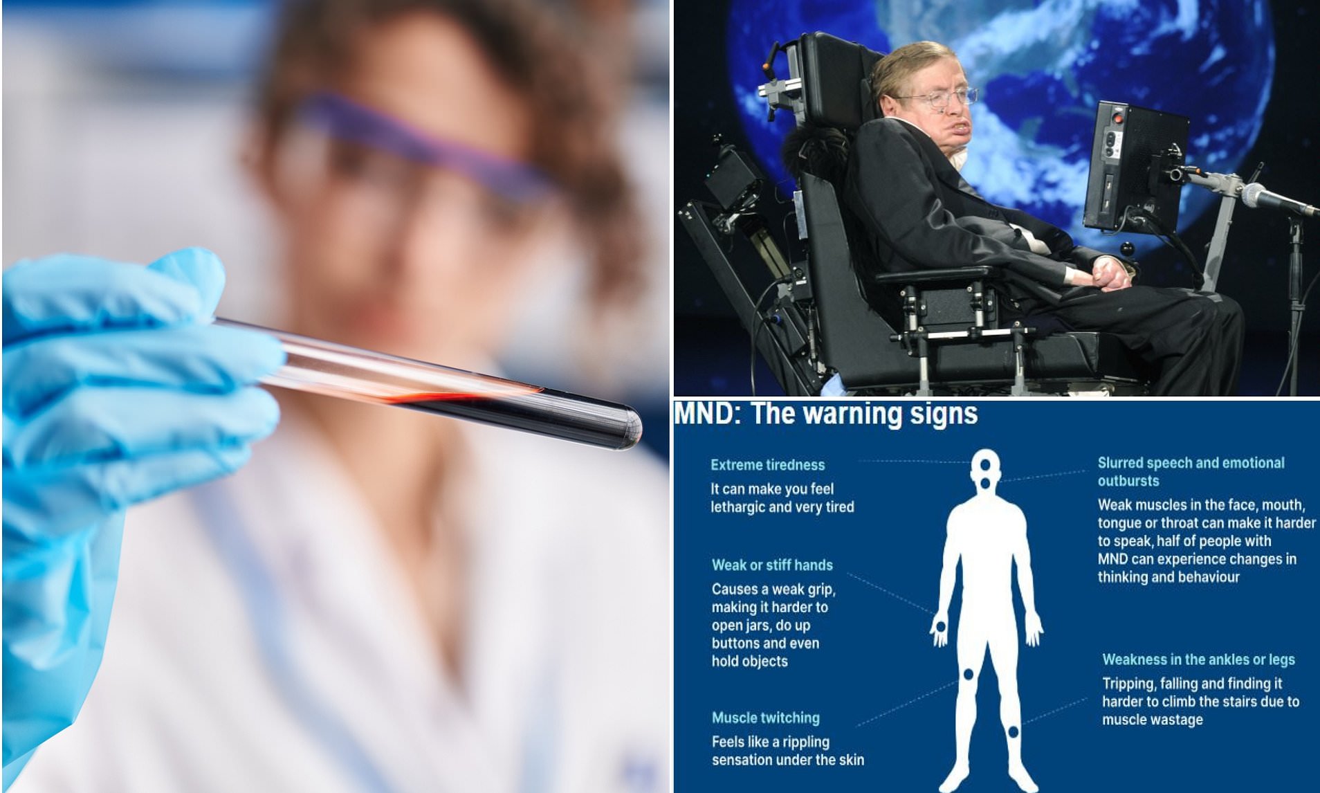 Breakthrough test could spot deadly motor neurone disease years before ...