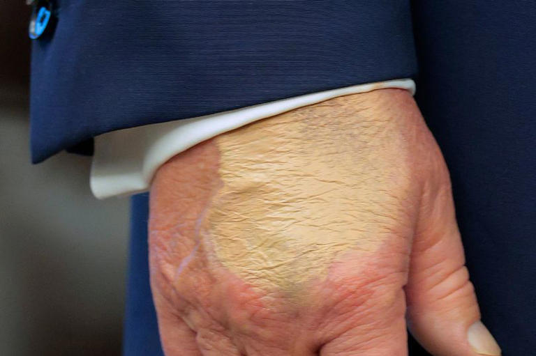 Trump's hand spotted with another huge dollop of make-up as health ...