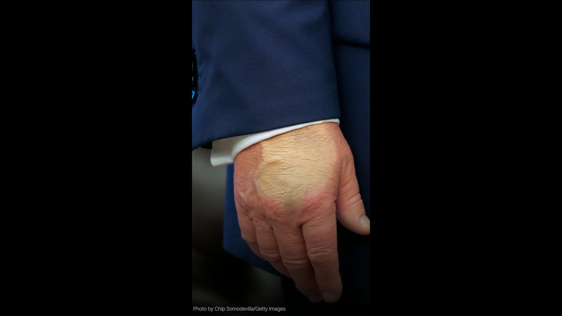 Trump’s Hand Makeup Sparks Debate About His Health..